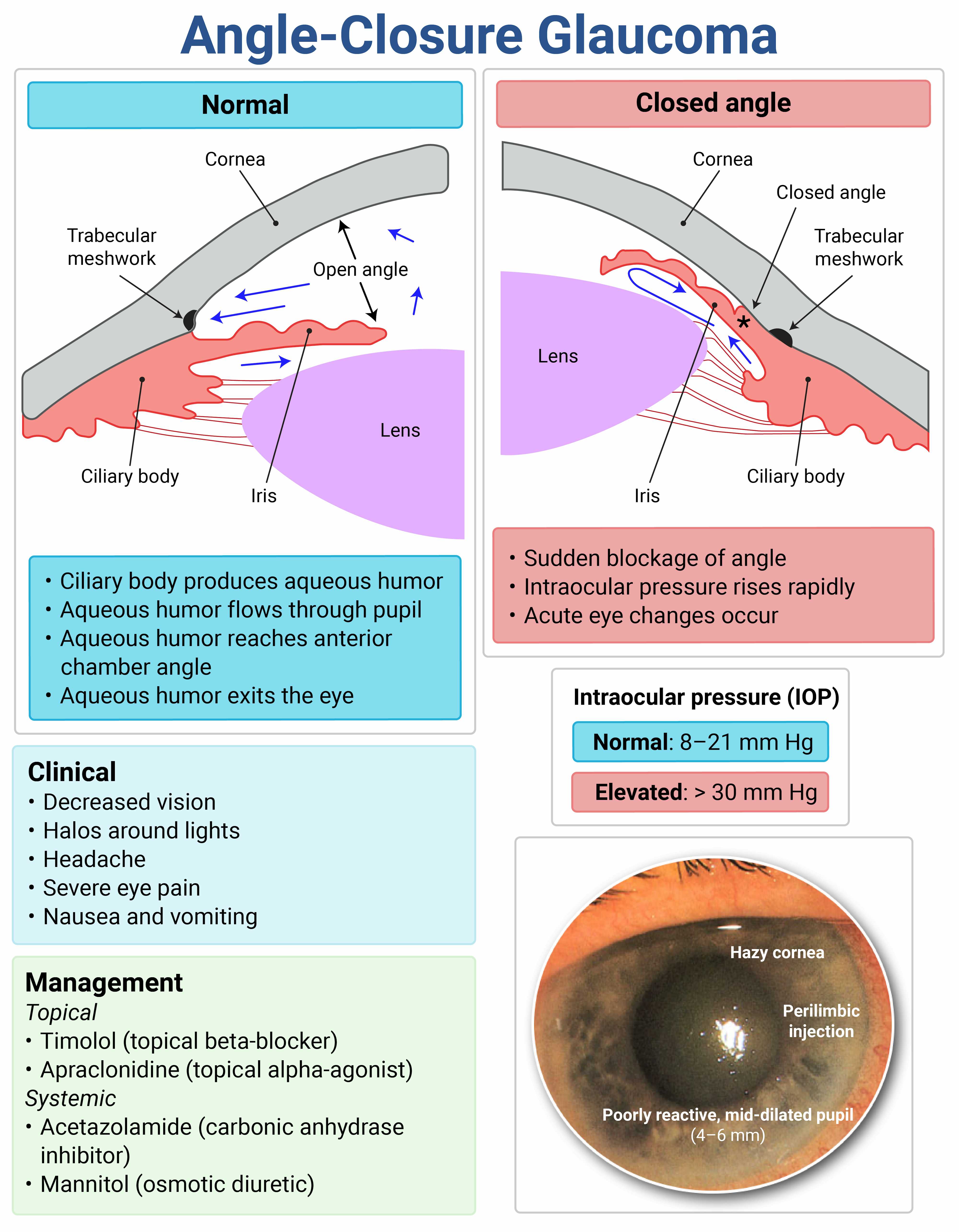 EM@3AM: Corneal Transplant Complications - emDocs